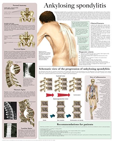 Ankylosing spondylitis e-chart: Quick reference guide by HC-HealthComm ...