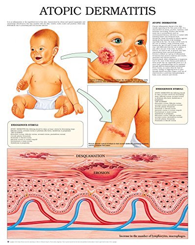 Atopic dermatitis: Full illustrated by HC-HealthComm | Goodreads