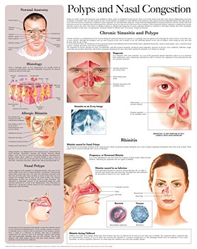 Polyps and Nasal Congestion e-chart: Full illustrated by HC-HealthComm ...