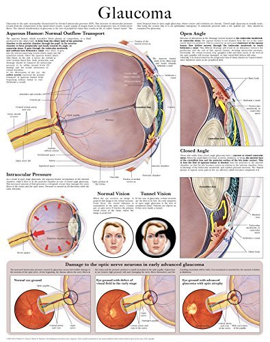 Glaucoma e chart: Full illustrated by HC-HealthComm | Goodreads