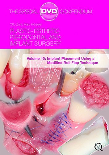 Plastic-Esthetic Periodontal and Implant Surgery, Volume 10: Implant Placement Using a Modified ...