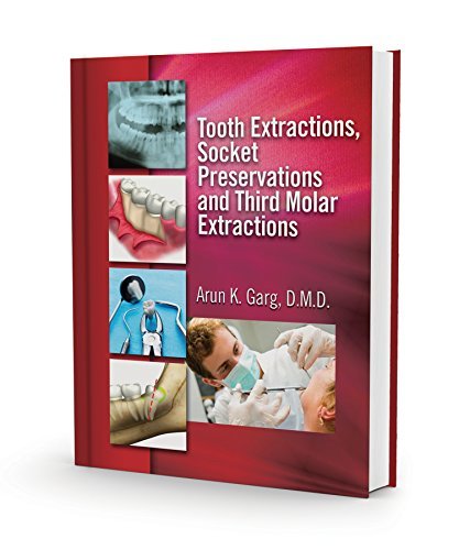 Tooth Extractions, Socket Preservations and Third Molar Extractions by ...