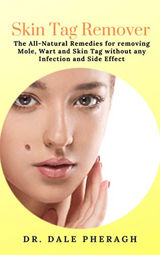 Skin Tag Remover: The All-Natural Remedies for removing Mole, Wart and ...