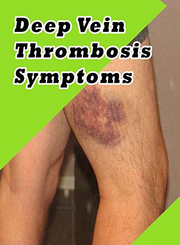 Deep Vein Thrombosis Symptoms: Swelling In The Legs, Feet, Ankles or ...