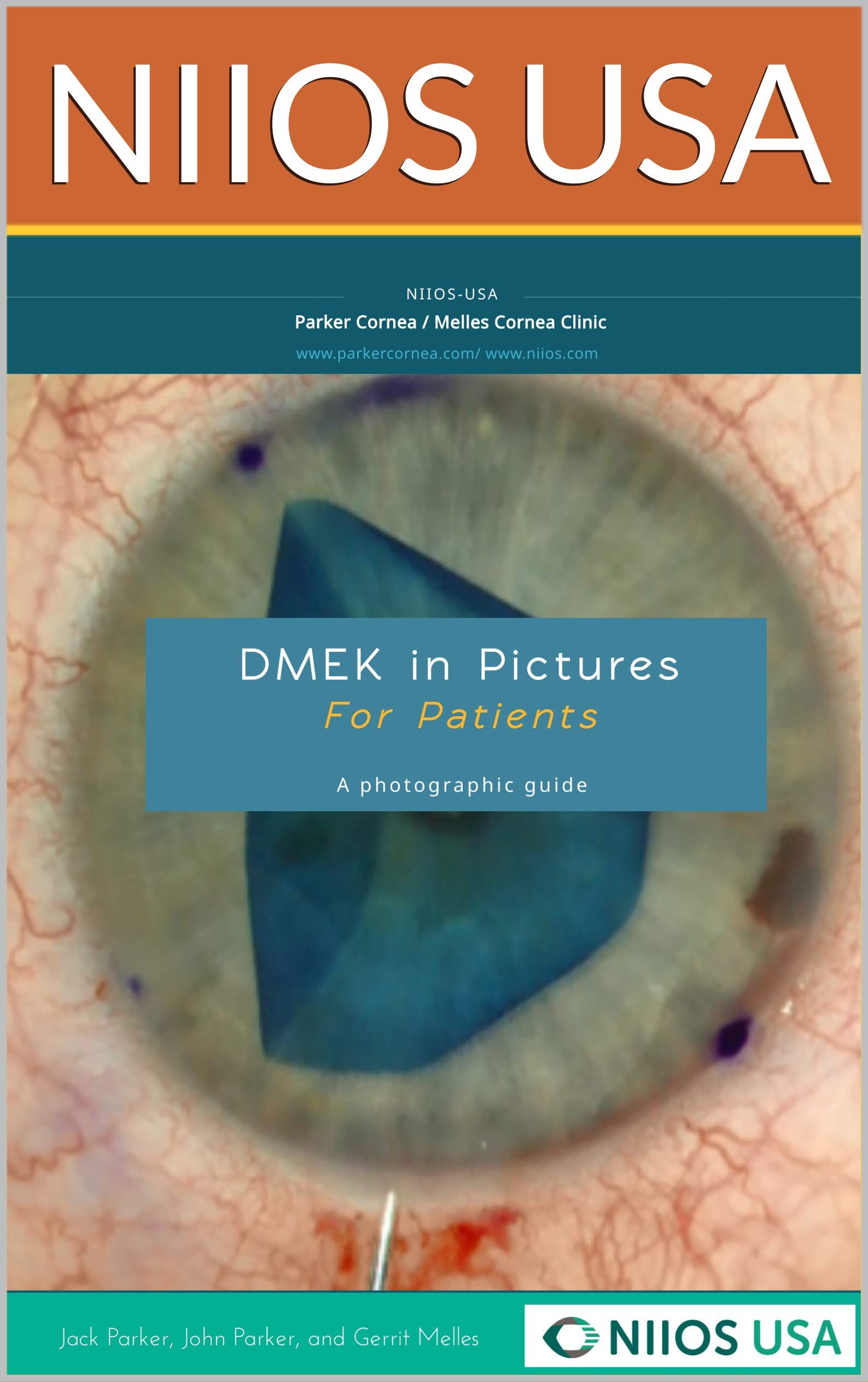 DMEK in Pictures, A patient's guide: a photographic guide by NIIOS USA ...