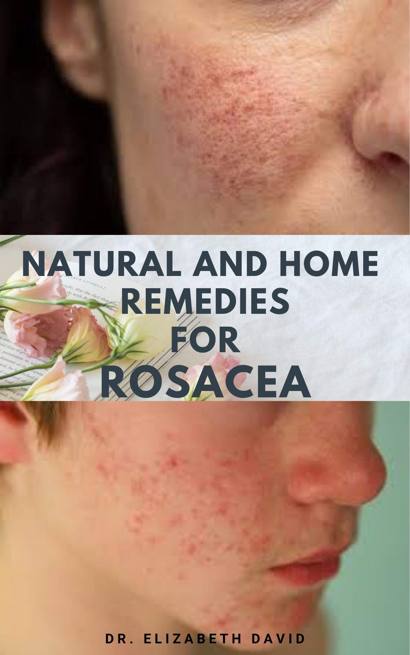 NATURAL AND HOME REMEDIES FOR ROSACEA: A Self Help Guide To Completely ...