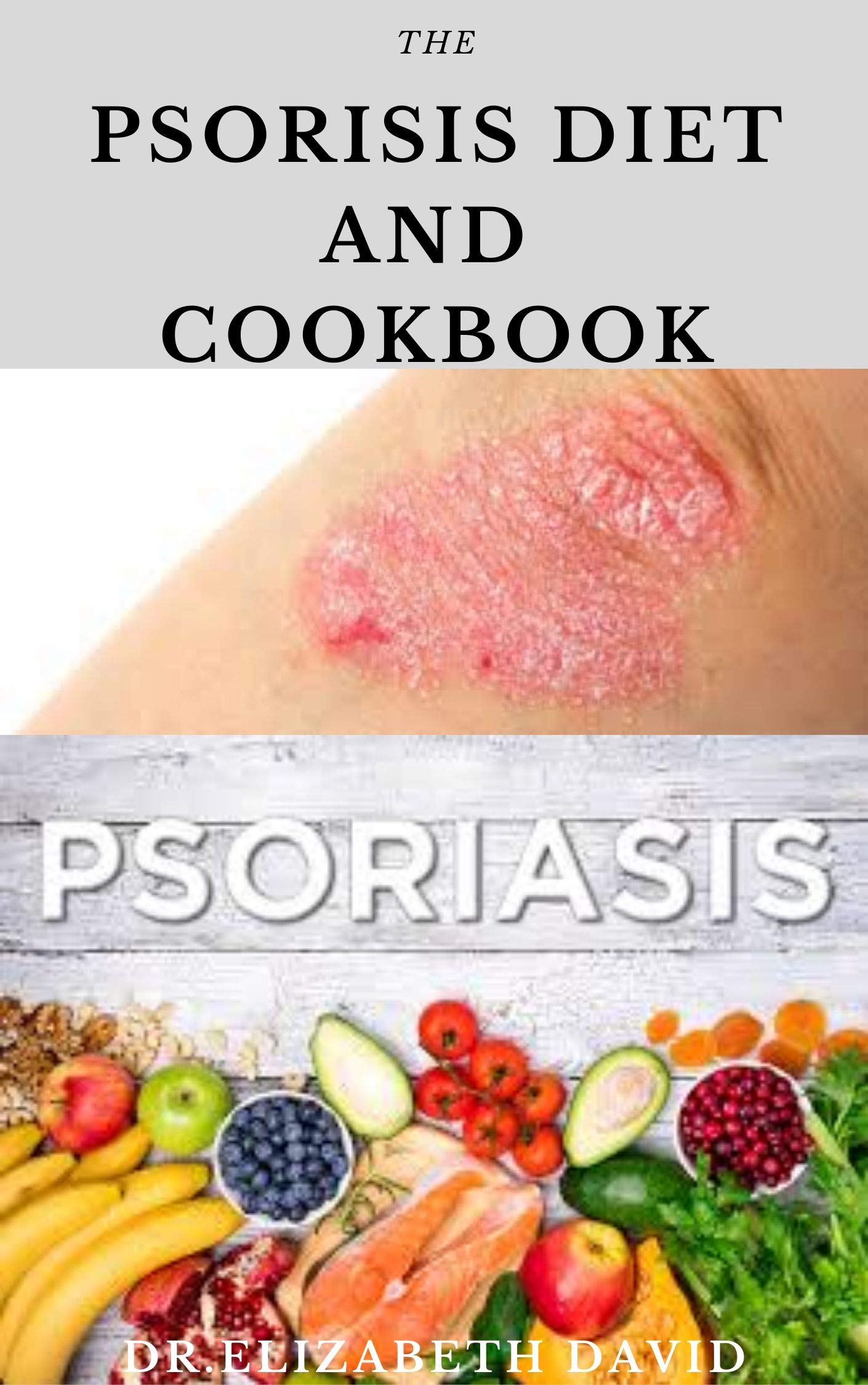 THE PSORIASIS DIET AND COOKBOOK: Dietary Guide For Preventing and ...