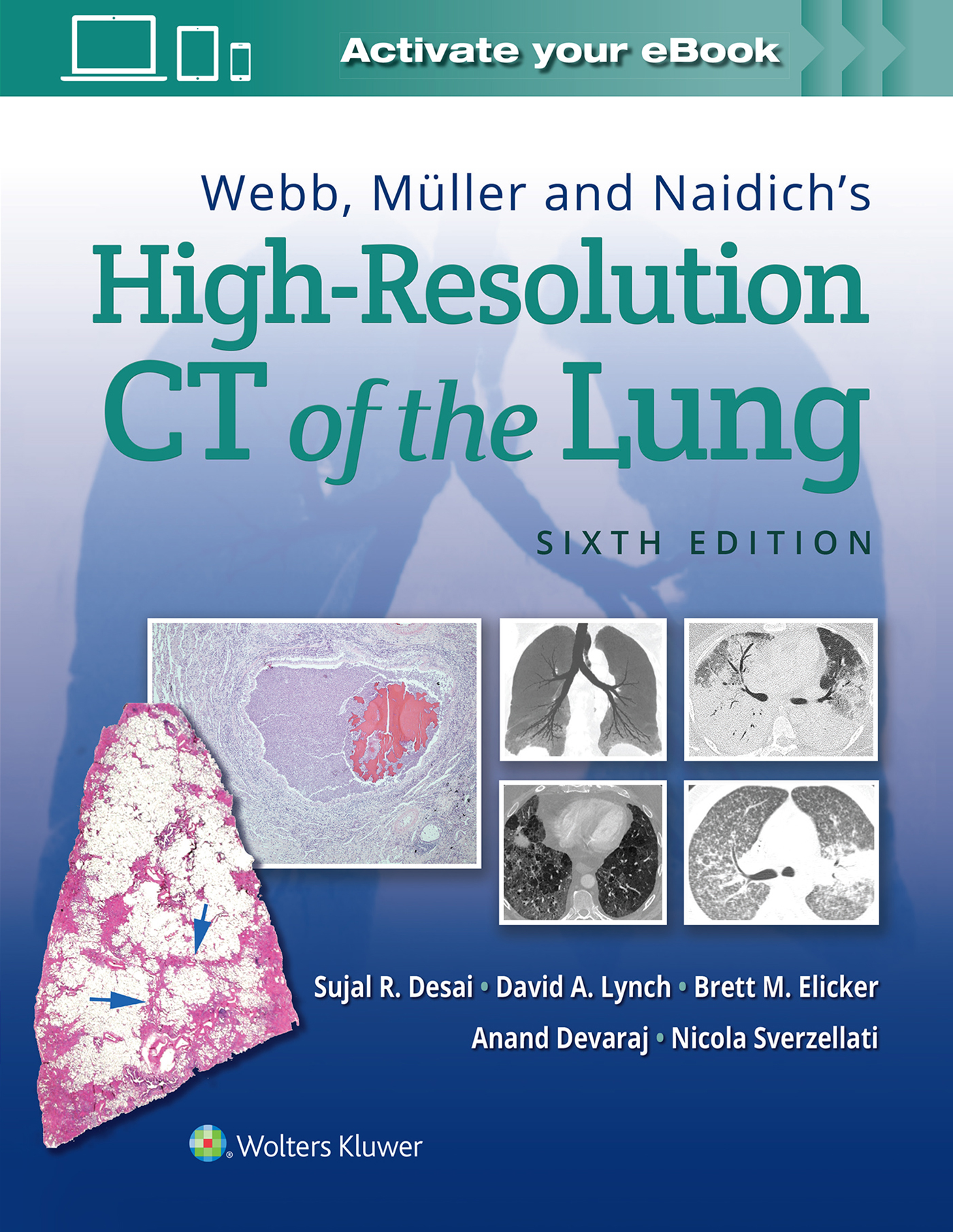 Webb, Müller and Naidich's High-Resolution CT of the Lung by Sujal ...