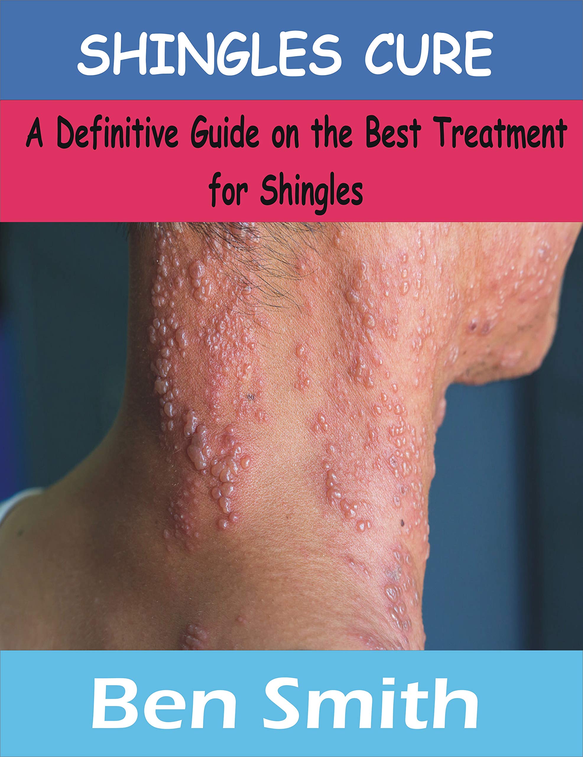 SHINGLES CURE: A Definitive Guide on the Best treatment for Shingles by ...