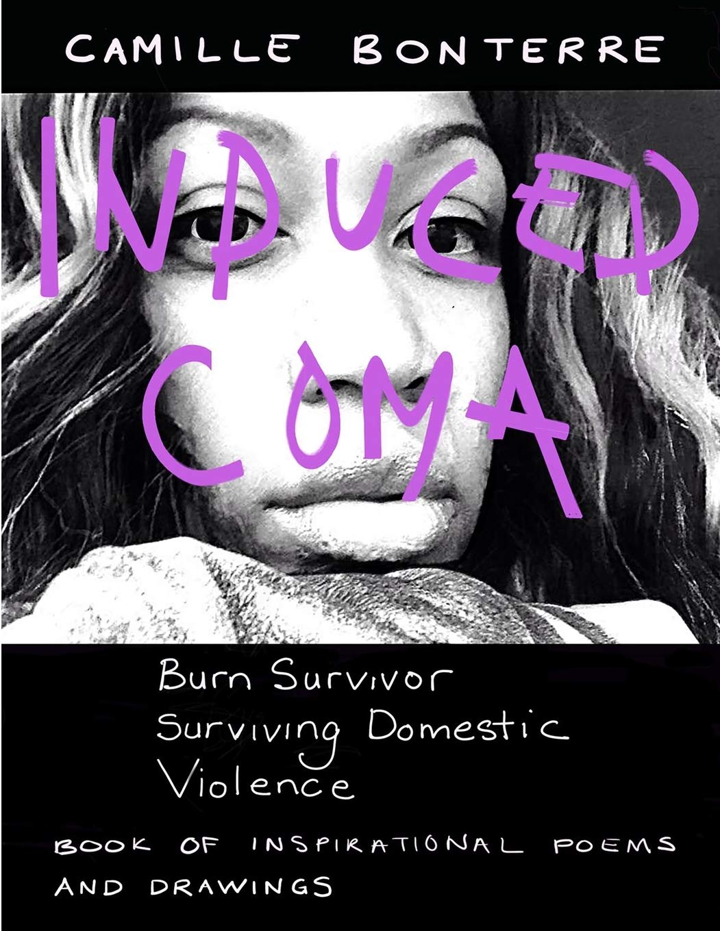 Induced Coma: Burn Survivor, Surviving Domestic Violence: Inspirational ...