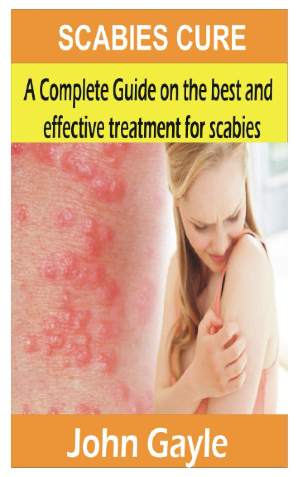 SCABIES CURE: A Complete Guide on the best and effective treatment for ...
