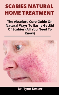 Scabies Natural Home Treatment: The Absolute Cure Guide On Natural Ways ...