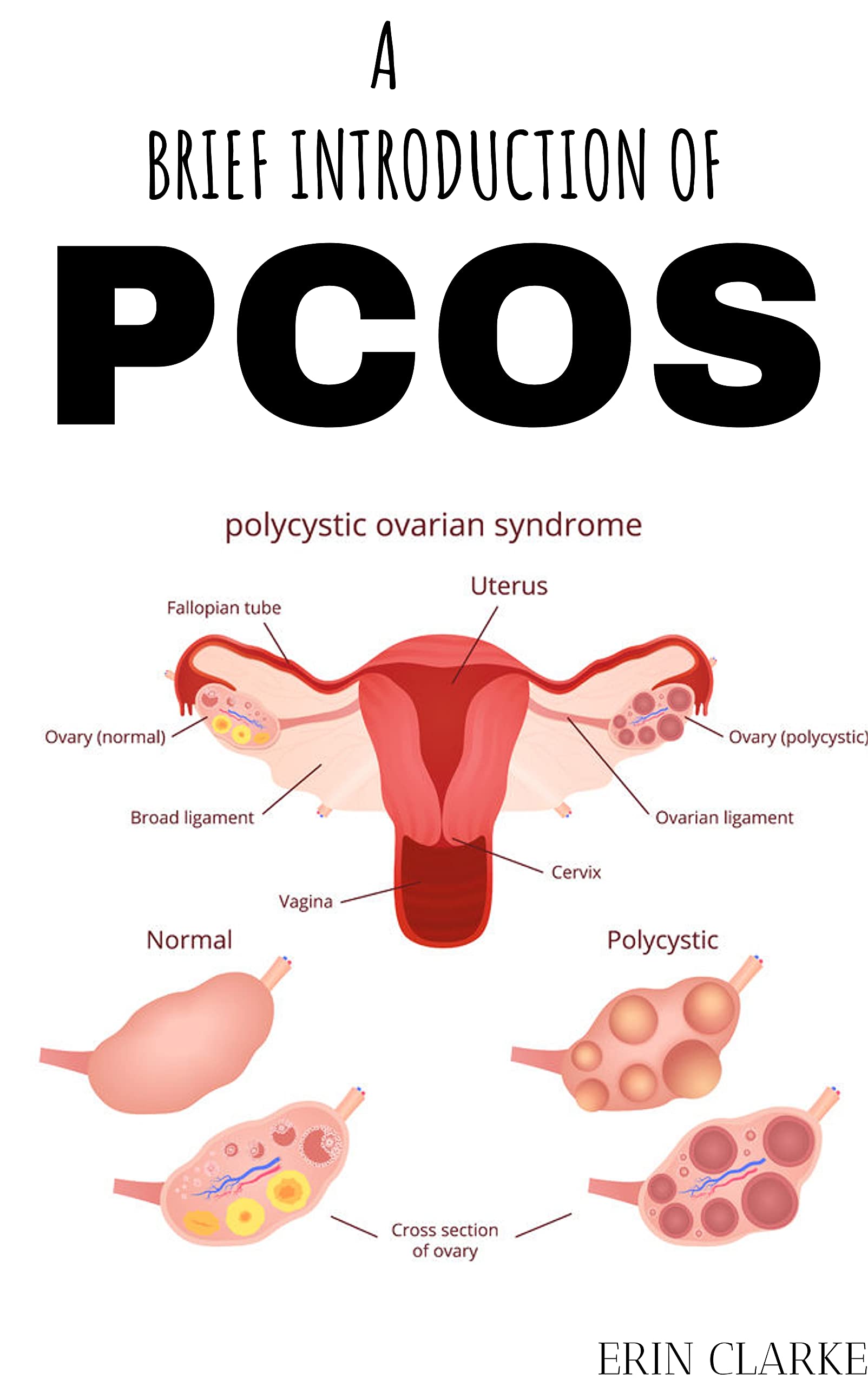 PCOS - A brief Introduction of Polycystic ovary syndrome by Azam Khan ...