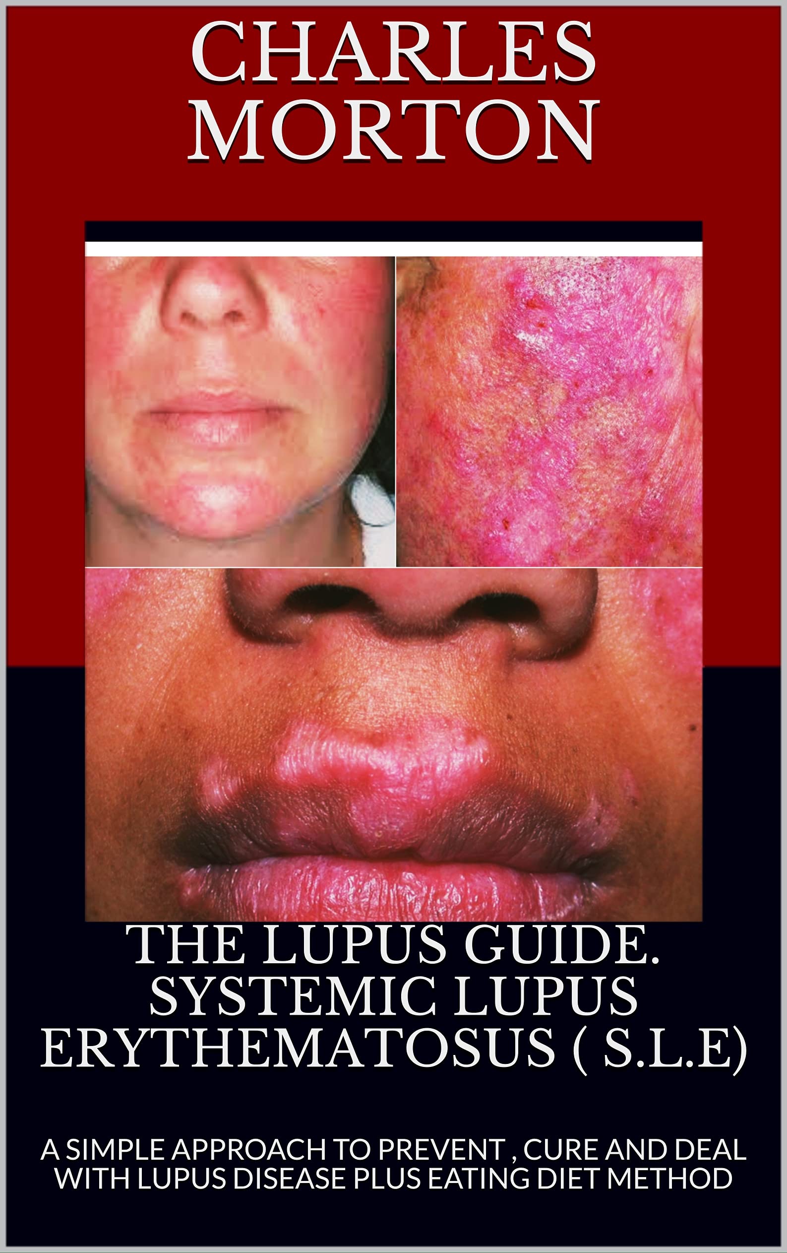 THE LUPUS GUIDE. SYSTEMIC LUPUS ERYTHEMATOSUS ( S.L.E): A SIMPLE ...