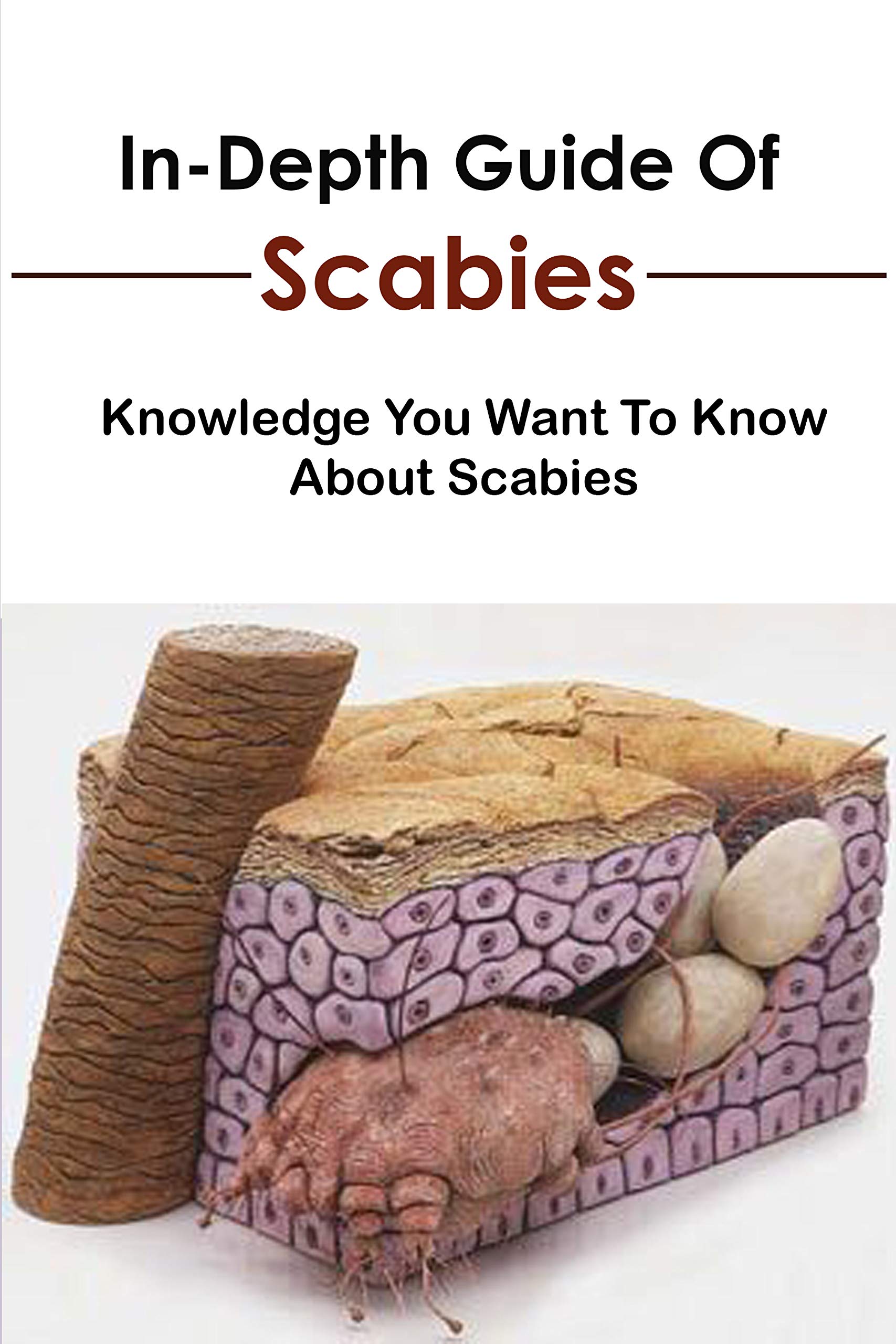 In-depth Guide Of Scabies_ Knowledge You Want To Know About Scabies ...