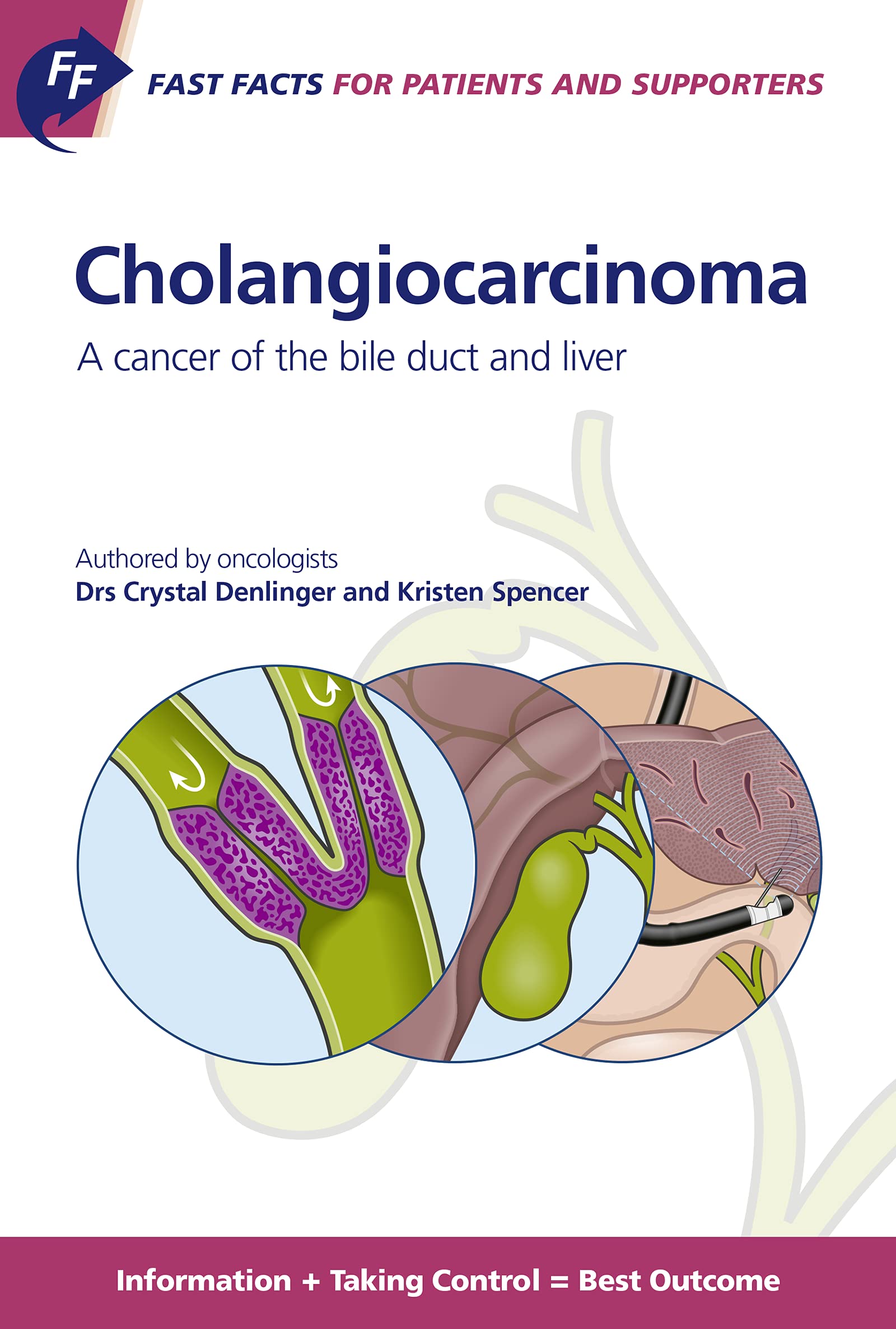 Fast Facts for Patients and Supporters: Cholangiocarcinoma: A Cancer of the Bile Duct and Liver ...