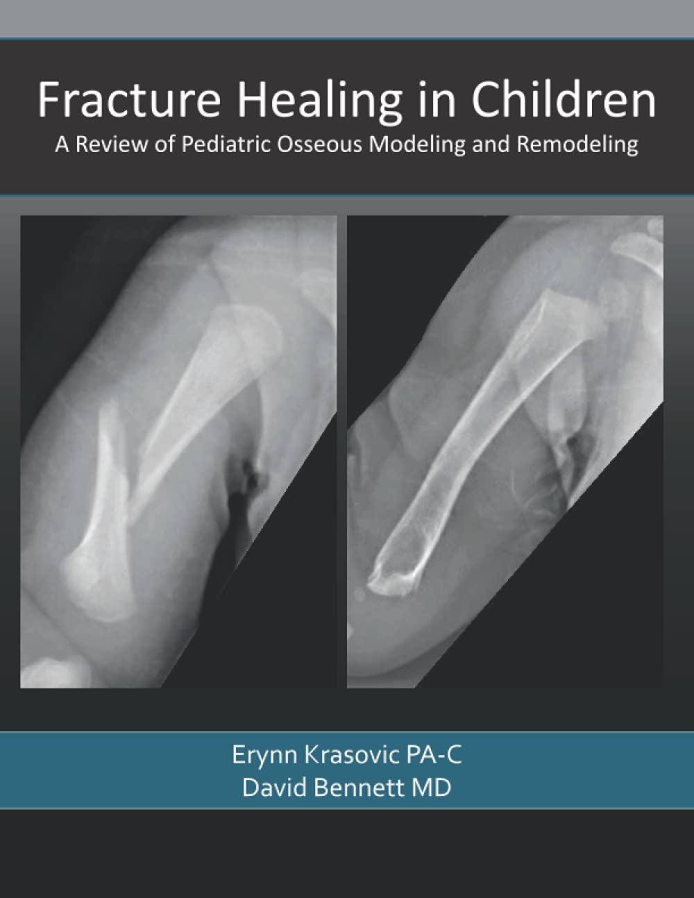 Fracture Healing in Children: A Review of Pediatric Osseous Modeling ...