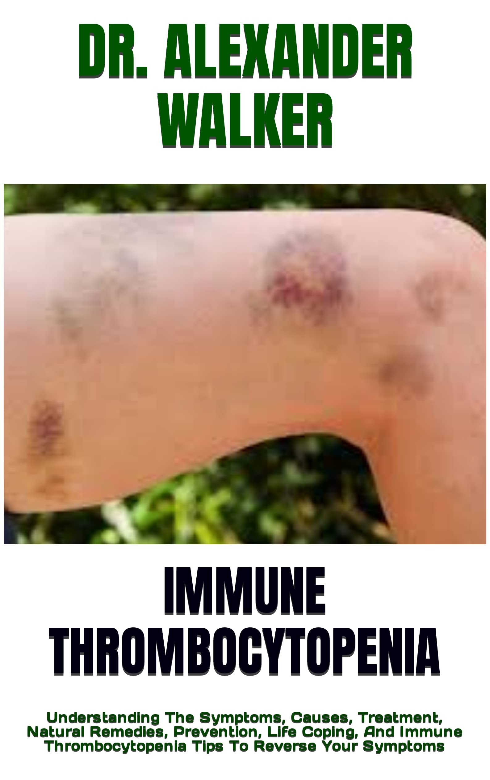 IMMUNE THROMBOCYTOPENIA: Understanding The Symptoms, Causes, Treatment ...