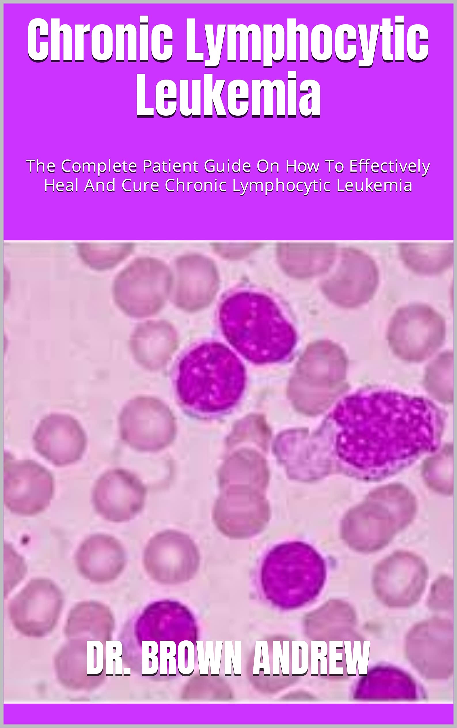 Chronic Lymphocytic Leukemia : The Complete Patient Guide On How To ...