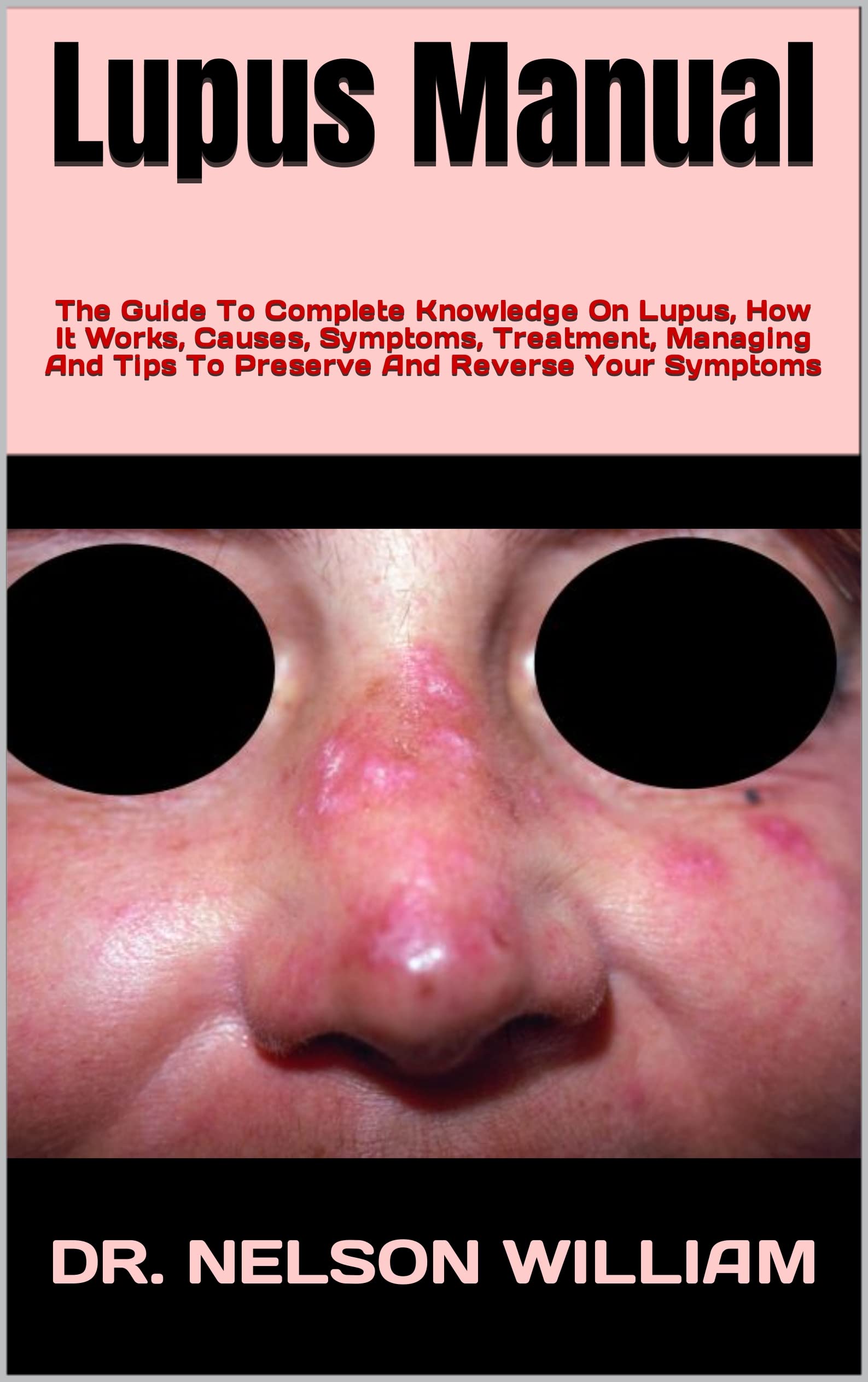 Lupus Manual : The Guide To Complete Knowledge On Lupus, How It Works ...