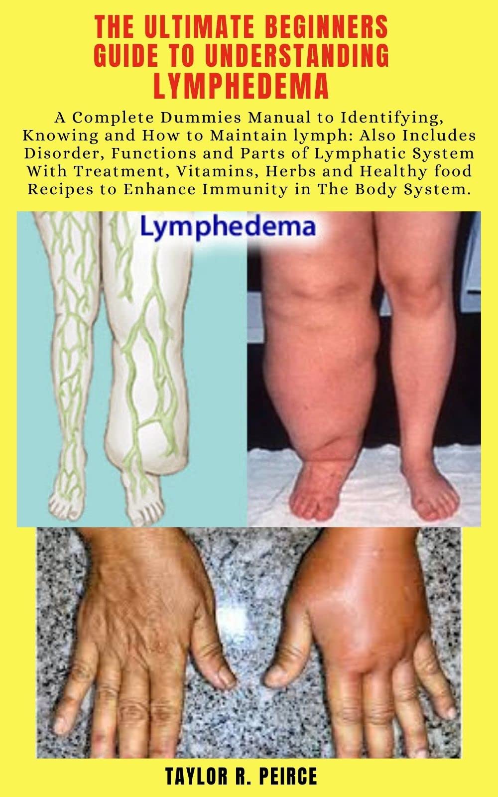 THE ULTIMATE BEGINNERS GUIDE TO UNDERSTANDING LYMPHEDEMA: A Complete ...