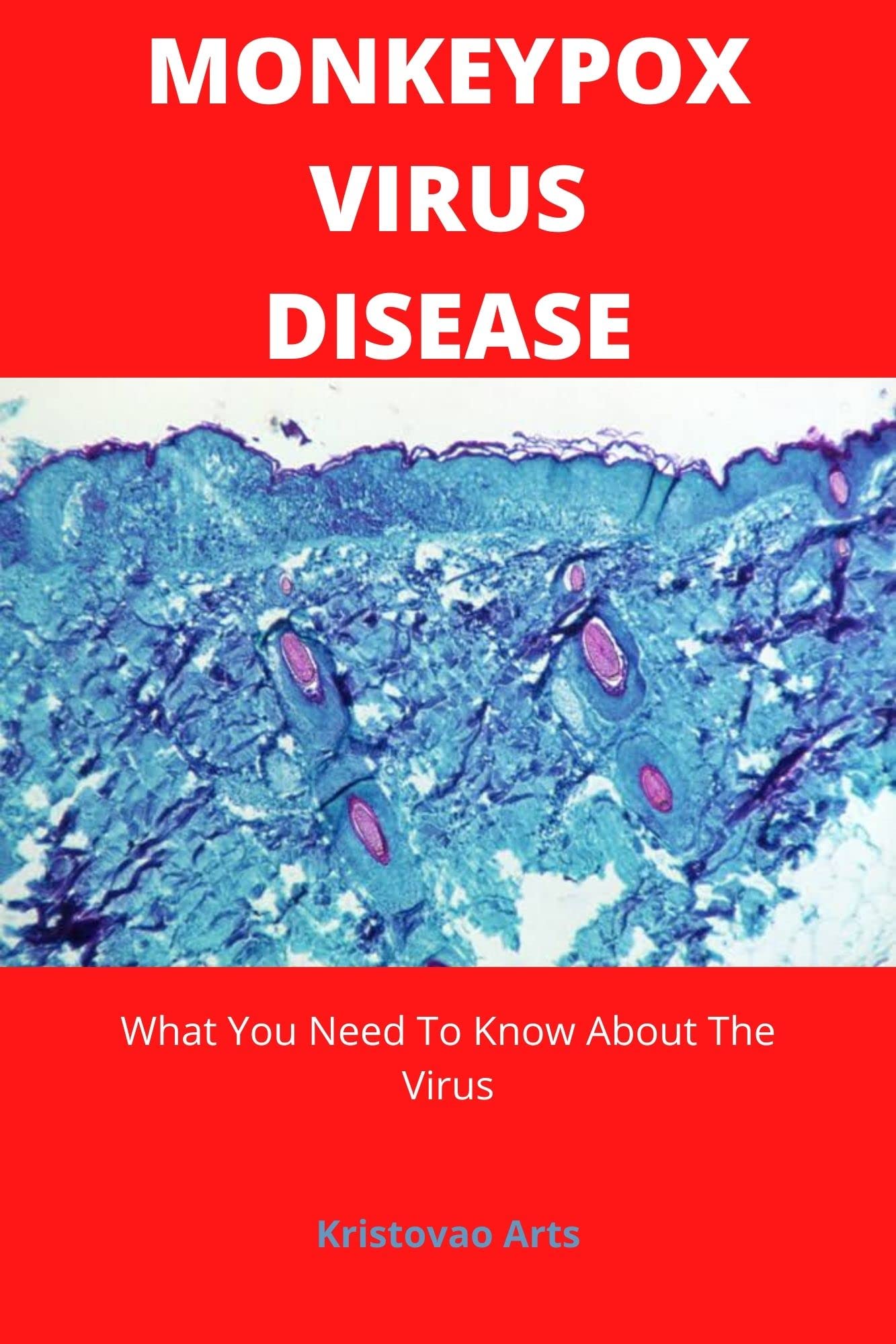 MONKEYPOX VIRUS DISEASE: What You Need To Know About The Virus by ...