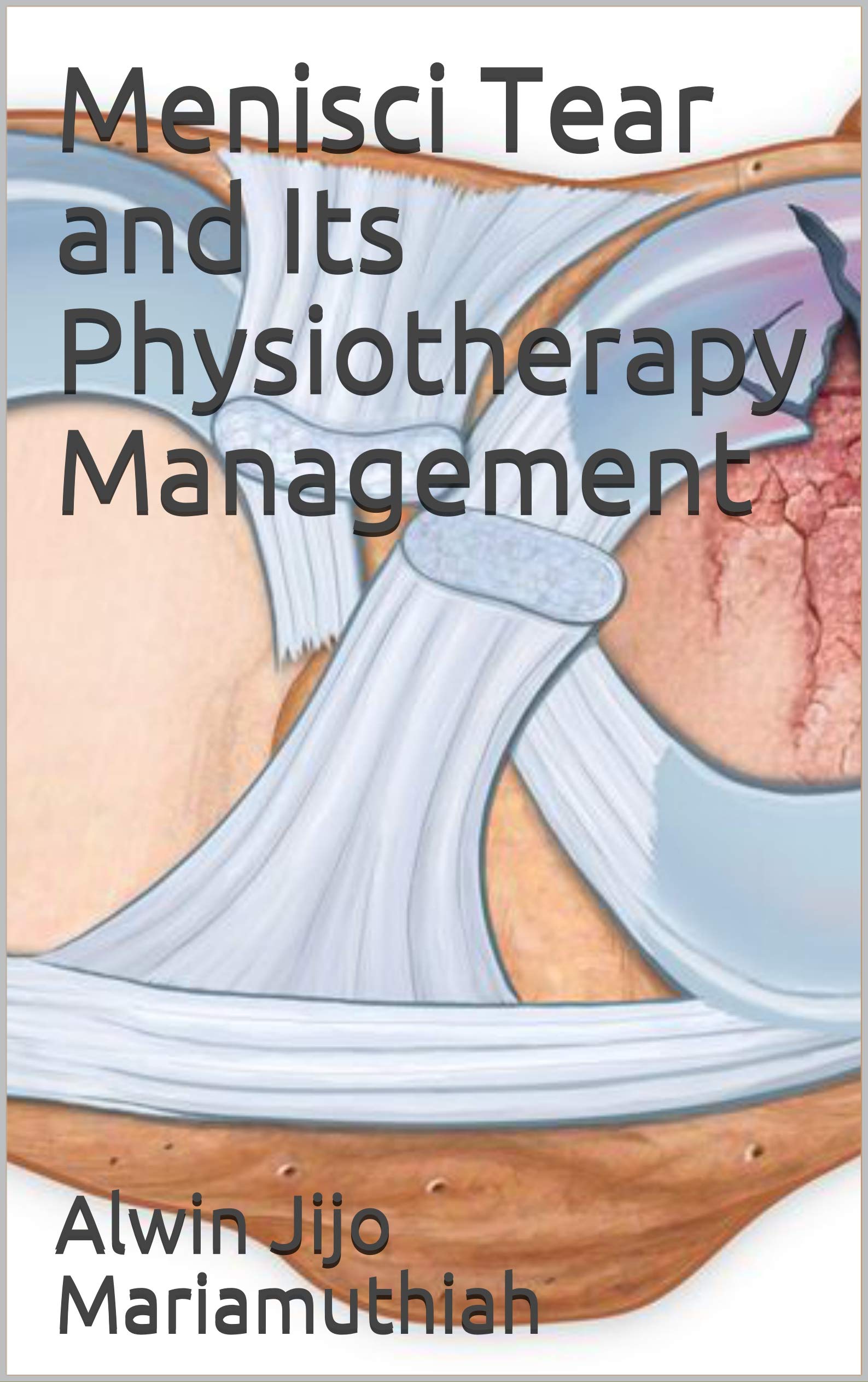 Menisci Tear and Its Physiotherapy Management by Alwin Jijo ...