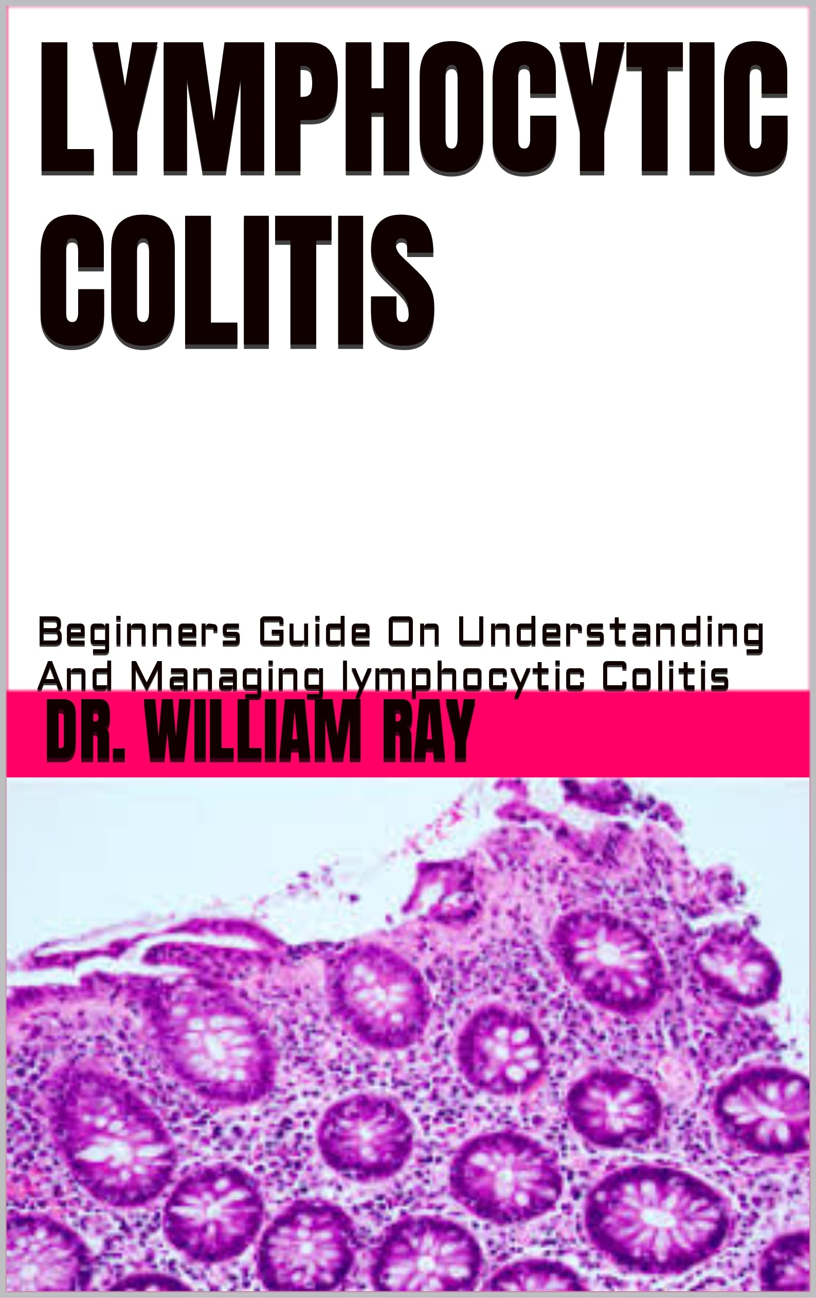 LYMPHOCYTIC COLITIS: Beginners Guide On Understanding And Managing ...