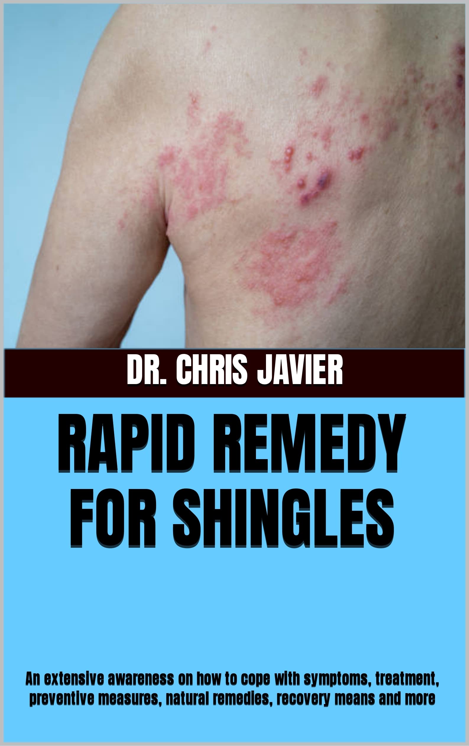 RAPID REMEDY FOR SHINGLES An Extensive Awareness On How To Cope With RAPID REMEDY FOR SHINGLES An Extensive Awareness On How To Cope With