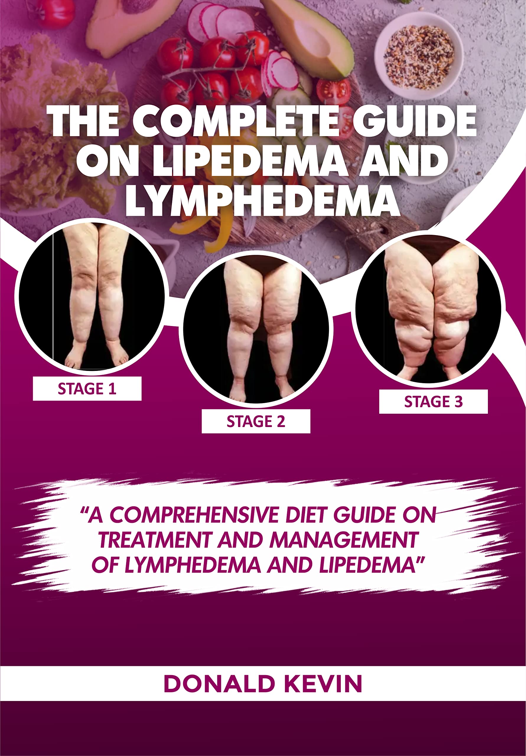 The Complete Guide on Lipedema and Lymphedema: A comprehensive Diet Guide on Treatment and ...
