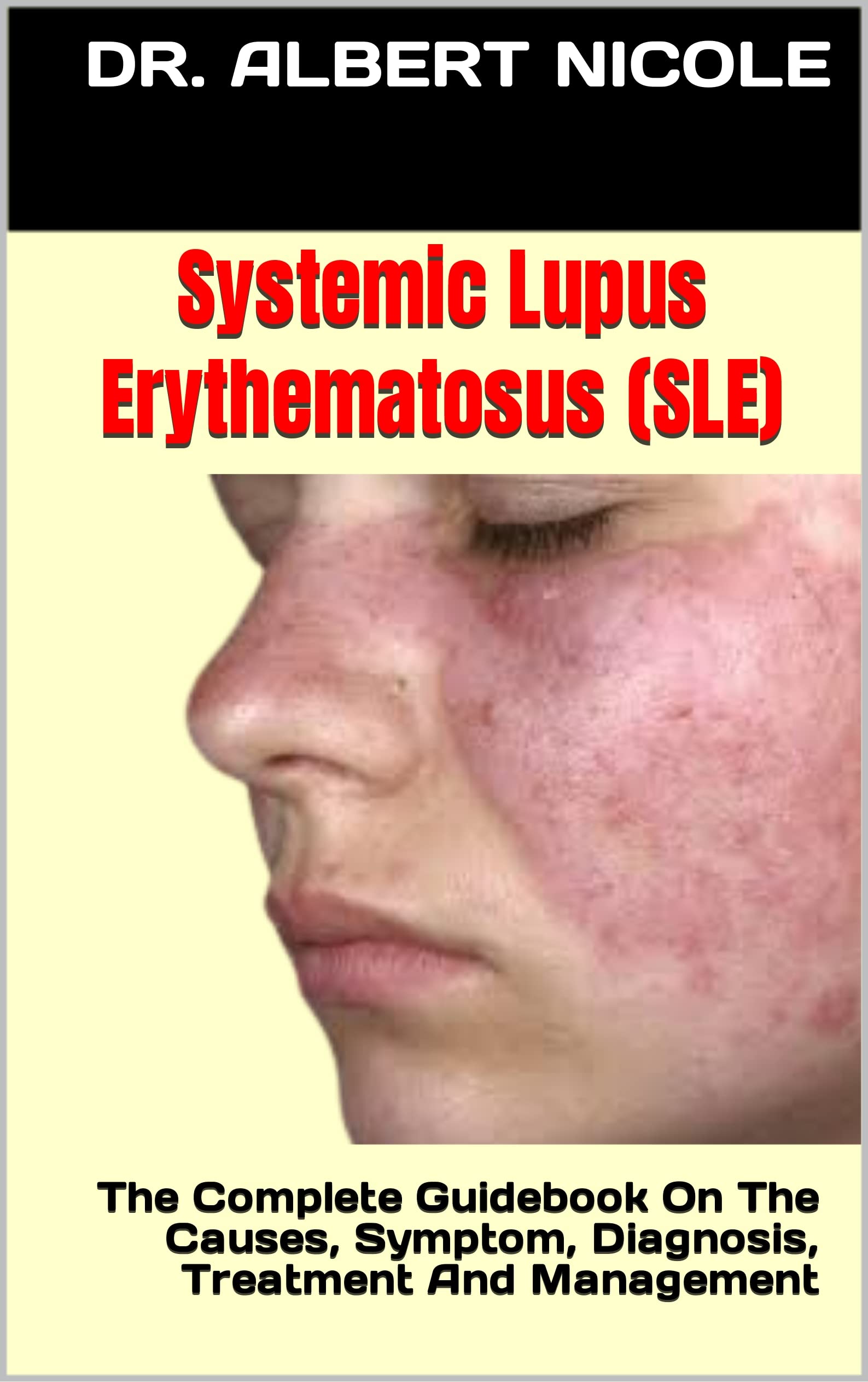 Systemic Lupus Erythematosus (SLE) : The Complete Guidebook On The ...