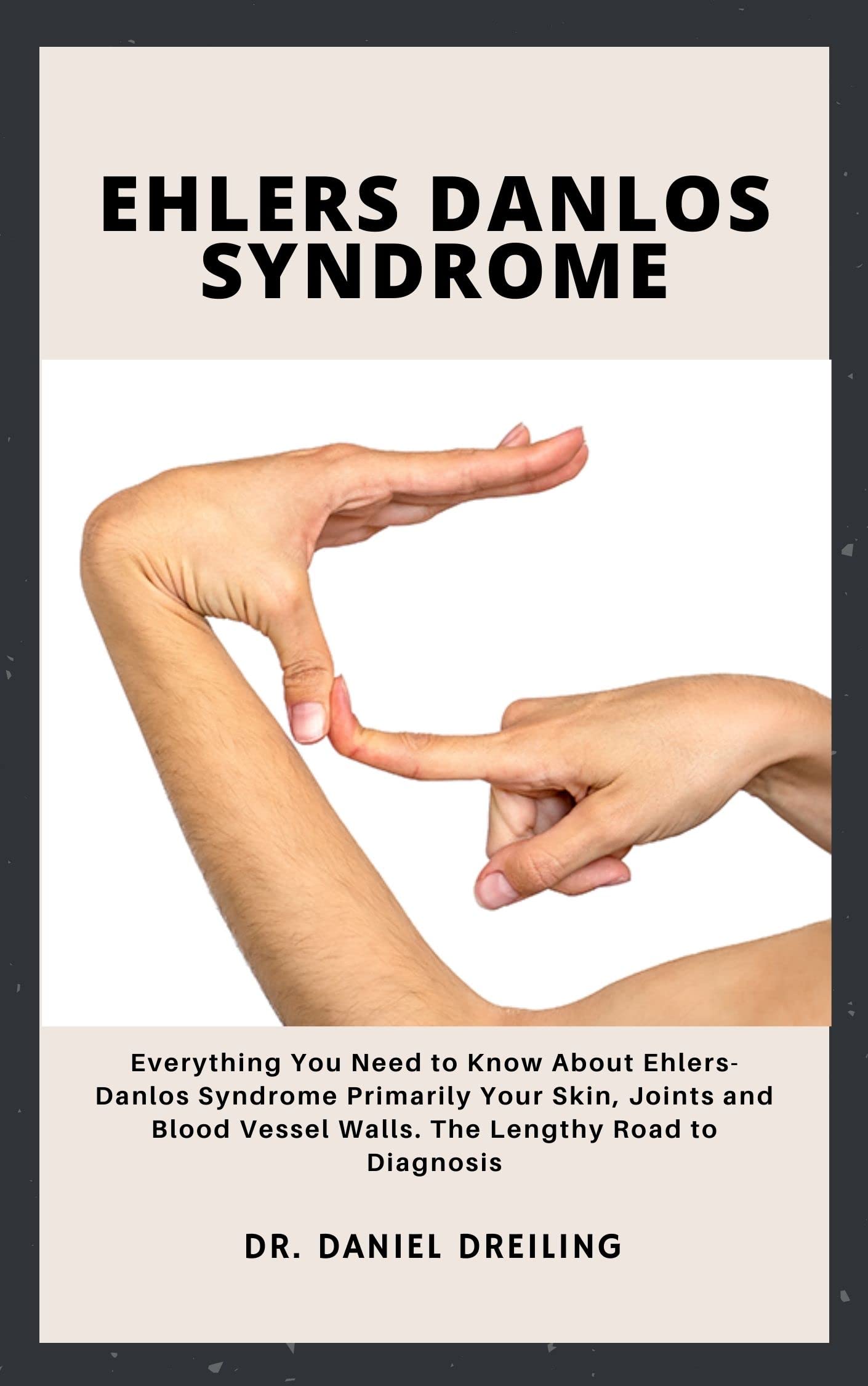 EHLERS DANLOS SYNDROME: Everything You Need to Know About Ehlers-Danlos ...