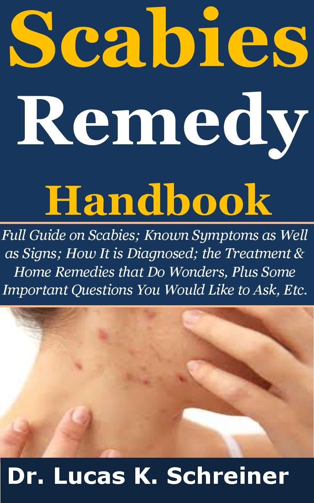 Scabies Remedy Handbook: Full Guide on Scabies; Known Symptoms as Well ...