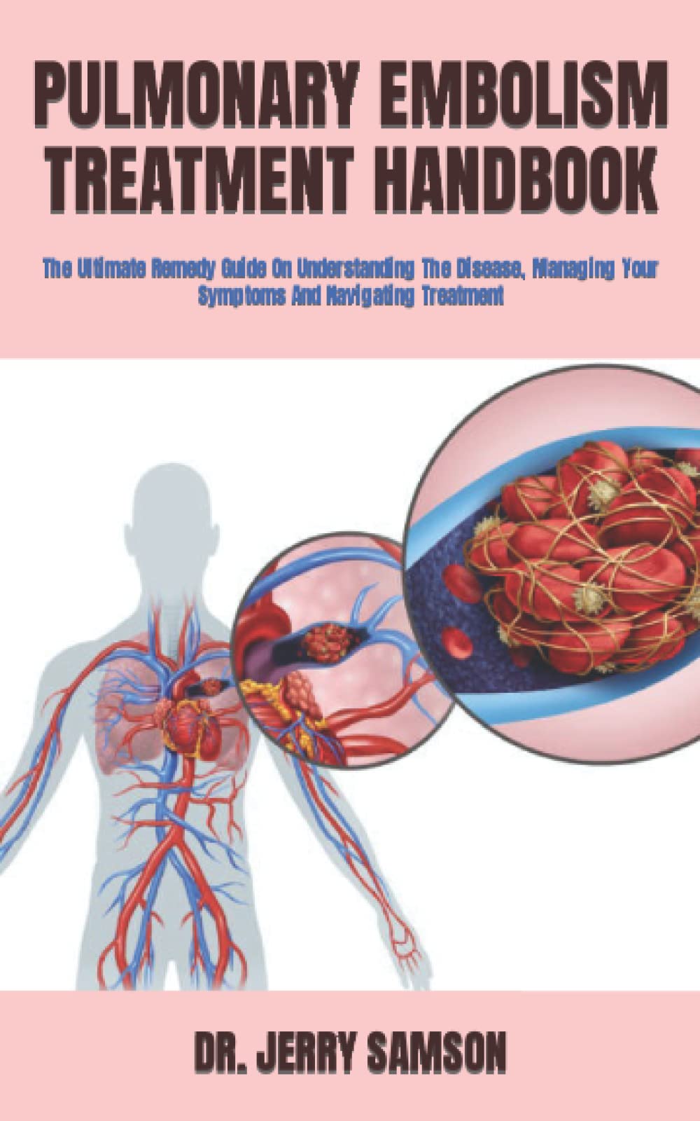 PULMONARY EMBOLISM TREATMENT HANDBOOK: The Ultimate Remedy Guide On ...