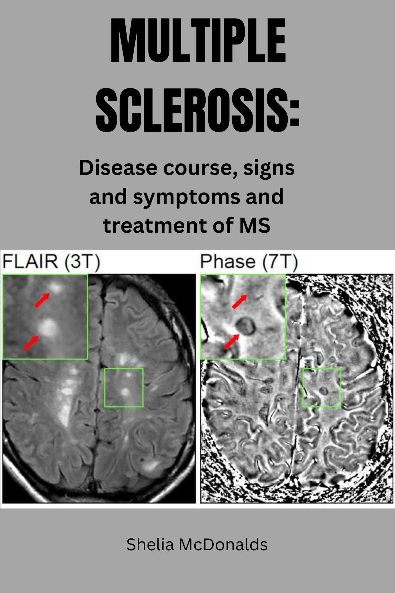 Multiple sclerosis : Disease course, signs and symptoms and treatment ...