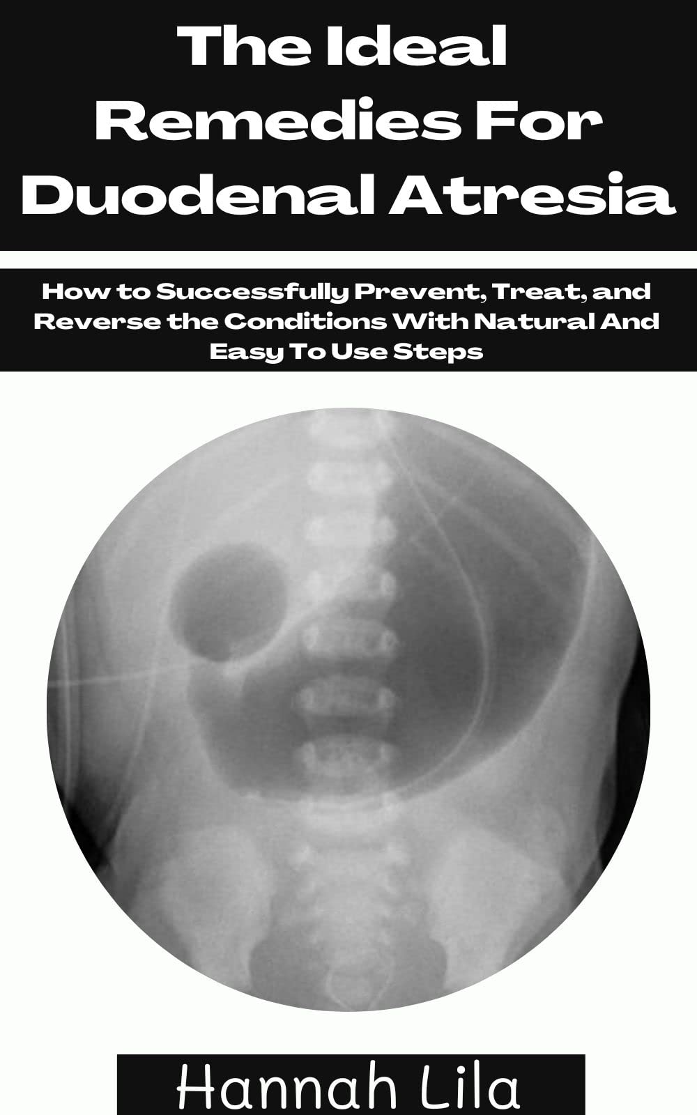 The Ideal Remedies For Duodenal Atresia: How to Successfully Prevent ...