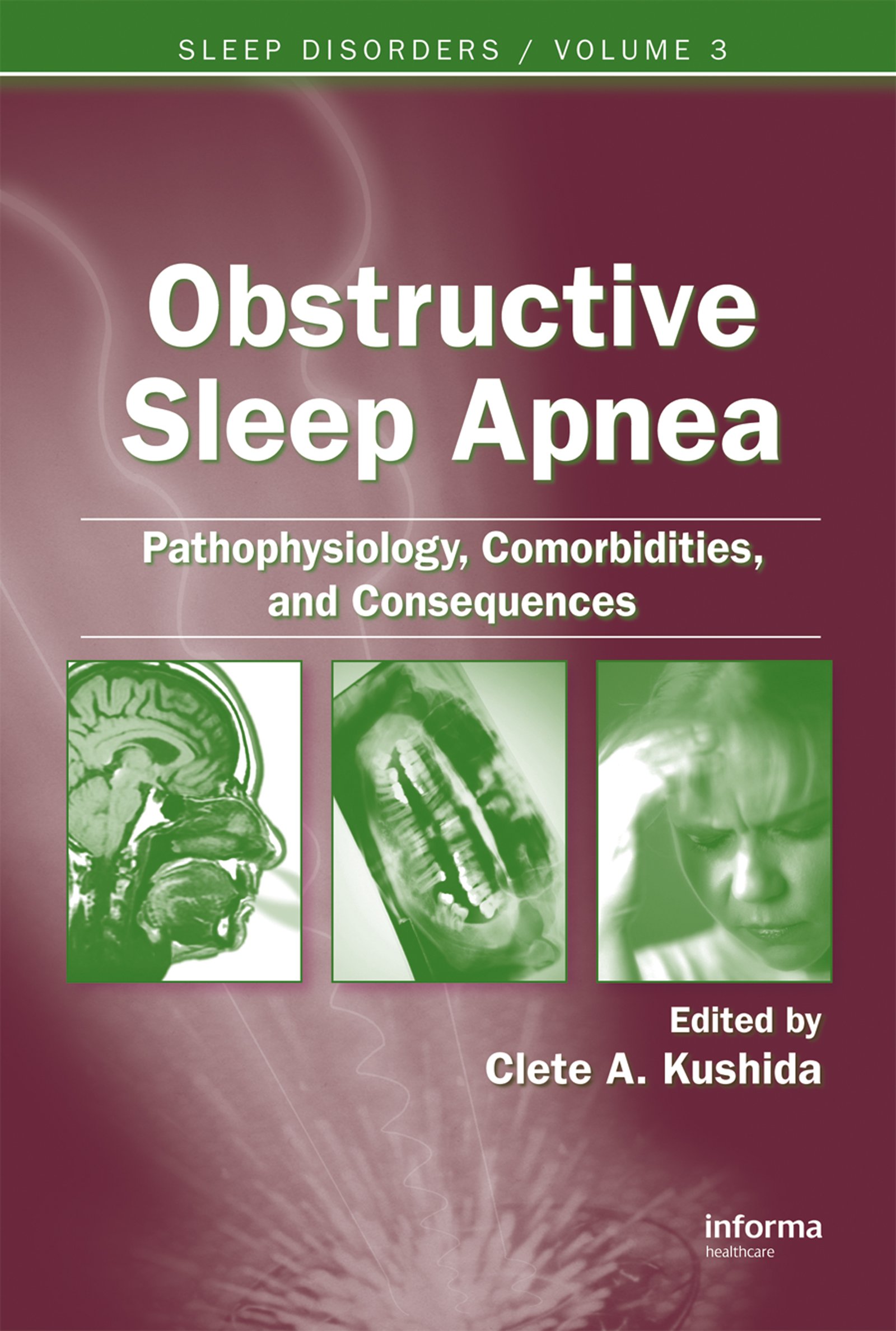 Obstructive Sleep Apnea: Pathophysiology, Comorbidities and ...