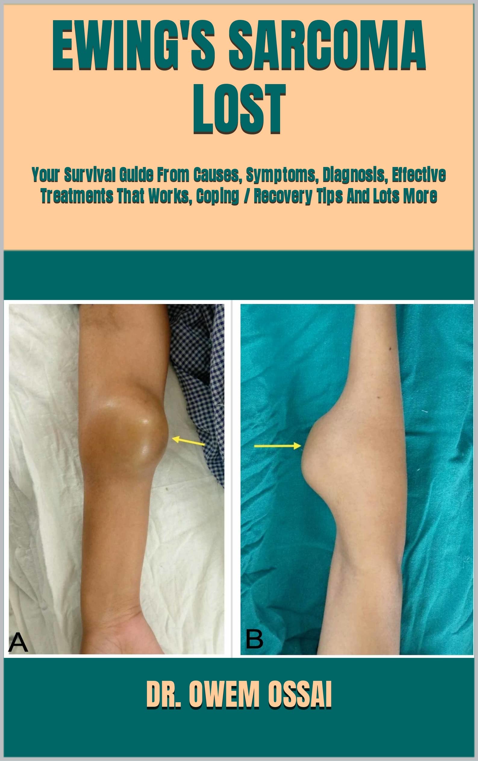 EWING'S SARCOMA LOST : Your Survival Guide From Causes, Symptoms, Diagnosis, Effective ...