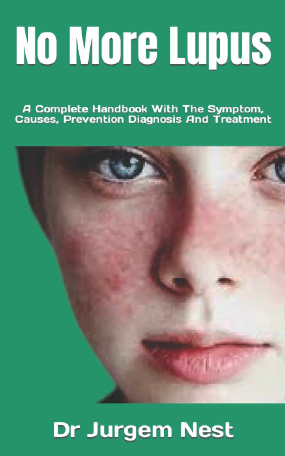 No More Lupus: A Complete Handbook With The Symptom, Causes, Prevention ...