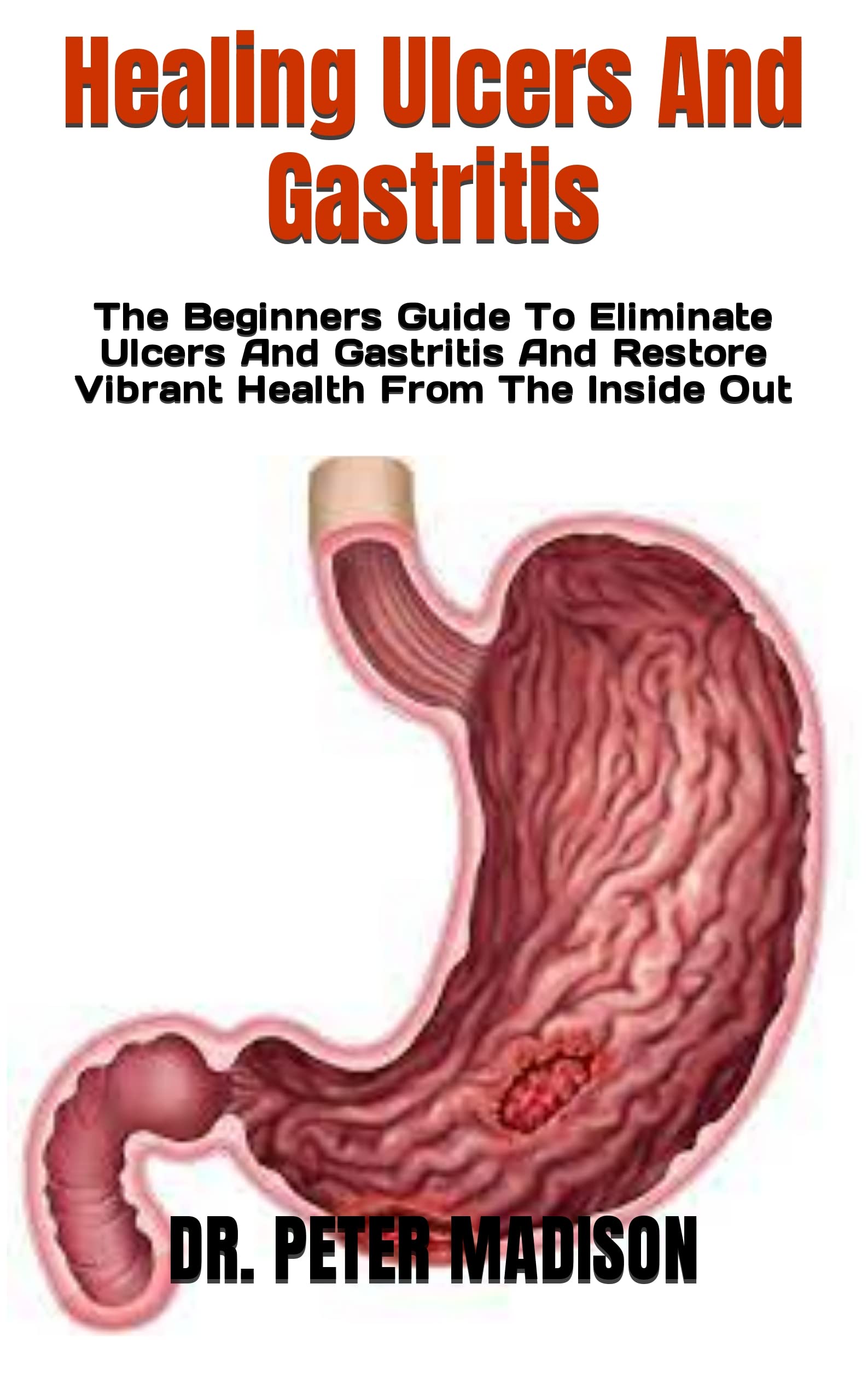 Healing Ulcers And Gastritis : The Beginners Guide To Eliminate Ulcers And Gastritis And Restore ...