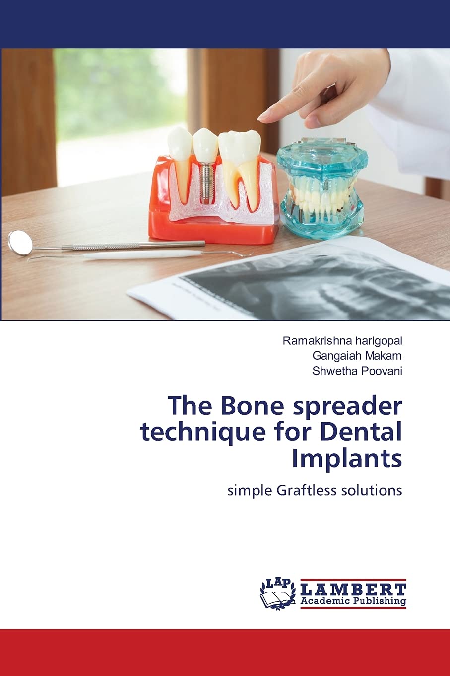 The Bone spreader technique for Dental Implants: simple Graftless ...