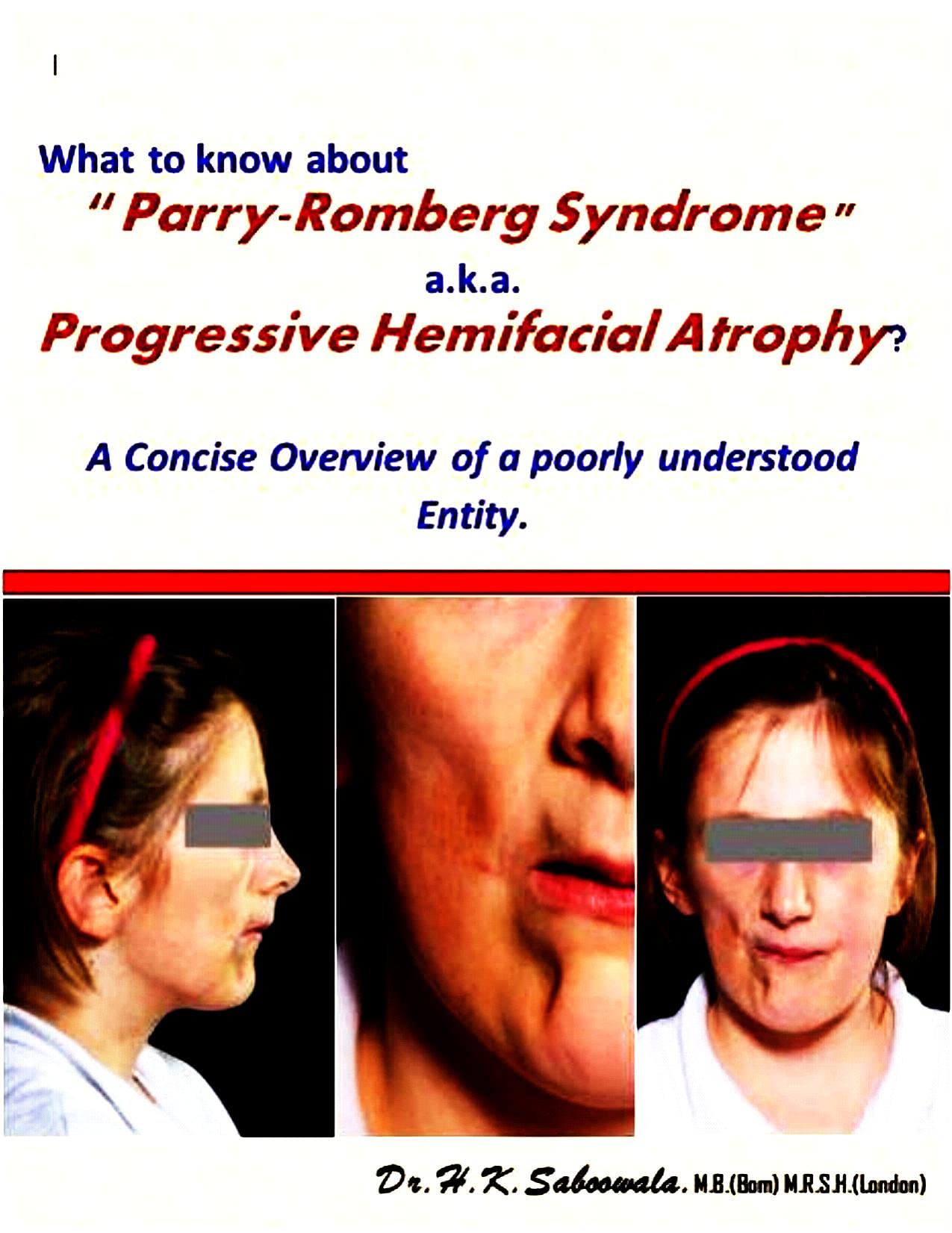 What to know about “Parry-Romberg Syndrome” a.k.a. Progressive ...