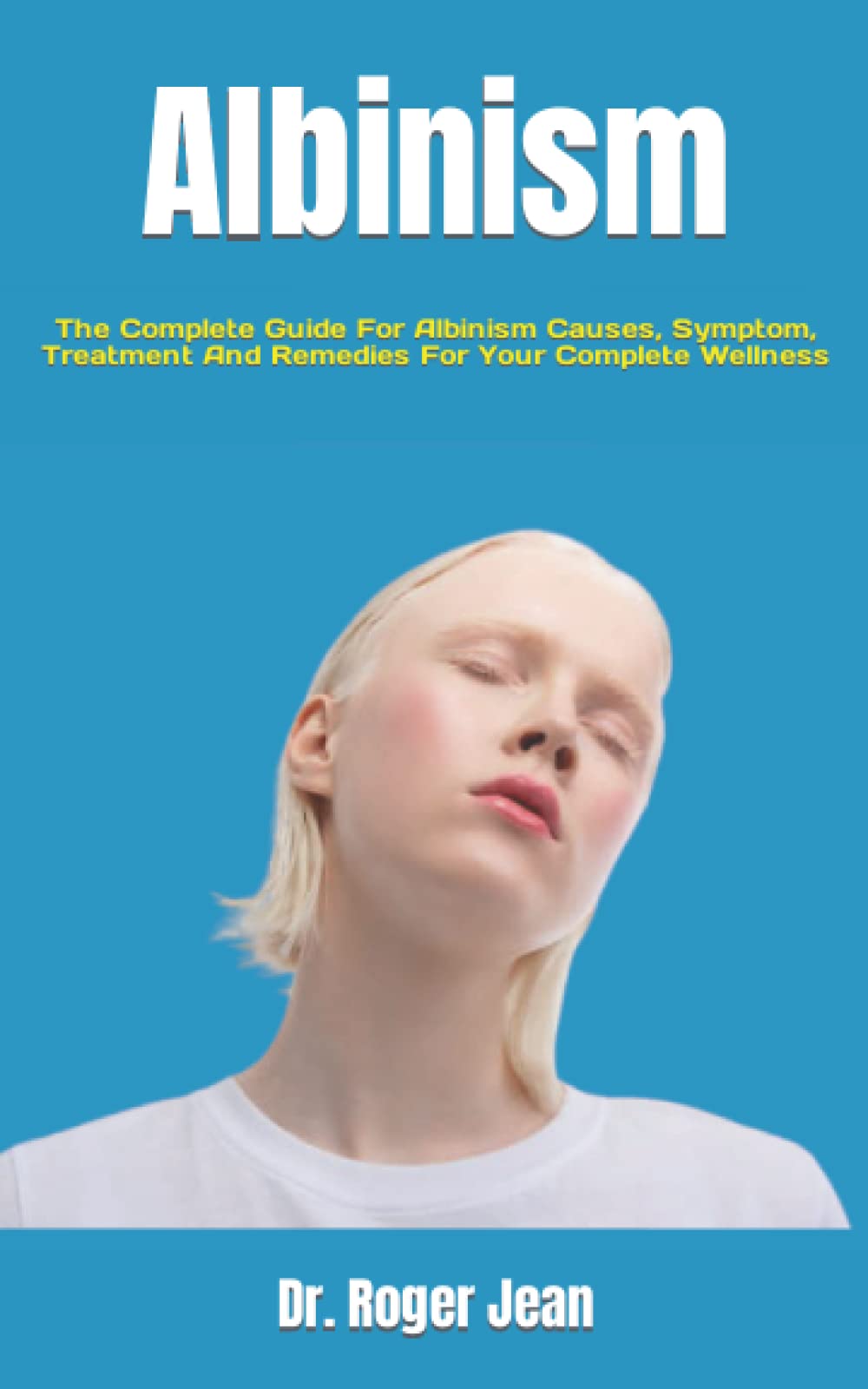 Albinism: The Complete Guide For Albinism Causes, Symptom, Treatment ...