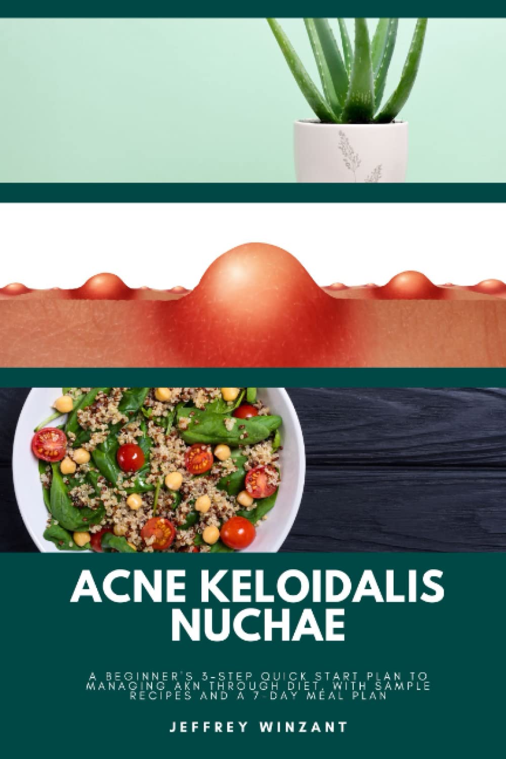 Acne Keloidalis Nuchae: A Beginner's 3-Step Quick Start Plan to ...