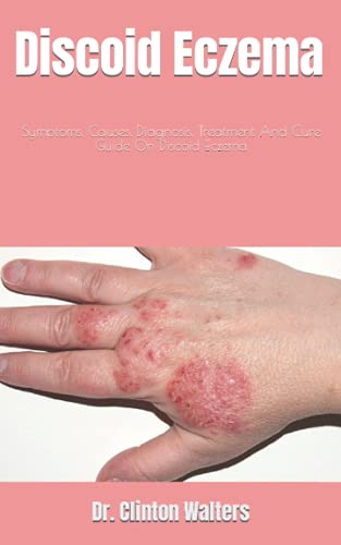 Discoid Eczema: Symptoms, Causes, Diagnosis, Treatment And Cure Guide ...