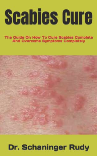 Scabies Cure: The Guide On How To Cure Scabies Complete And Overcome ...