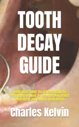 TOOTH DECAY GUIDE: TOOTH DECAY GUIDE: The Ultimate Guide On Everything ...
