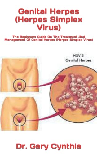 Genital Herpes (Herpes Simplex Virus): The Beginners Guide On The Treatment And Management Of ...