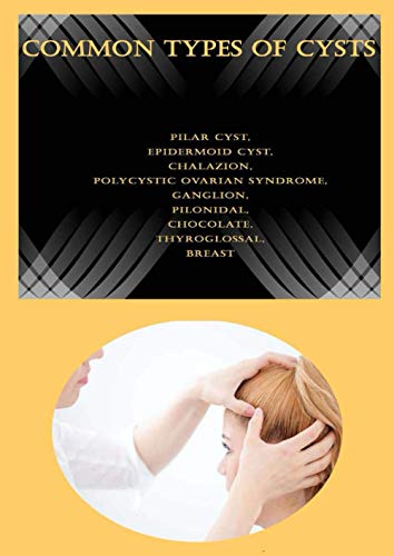 Common Types of Cysts: Pilar Cyst, Epidermoid Cyst, Chalazion ...