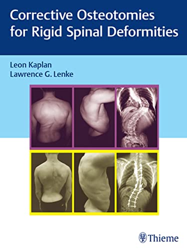 Corrective Osteotomies for Rigid Spinal Deformities by Leon Kaplan ...